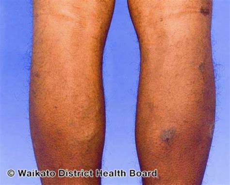 Discoid Eczema — Skin For All Discoid Eczema — Skin For All