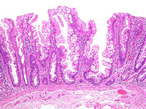 Sessile Polyp Histology