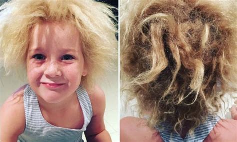 Esta Niña Sufre” Síndrome Del Cabello Impeinable Marcianos