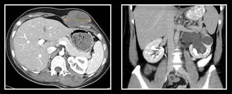 Tumor Desmoide Mobilemed