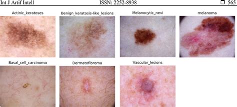 Figure 1 From Deep Ensemble Learning For Skin Lesions Classification With Convolutional Neural