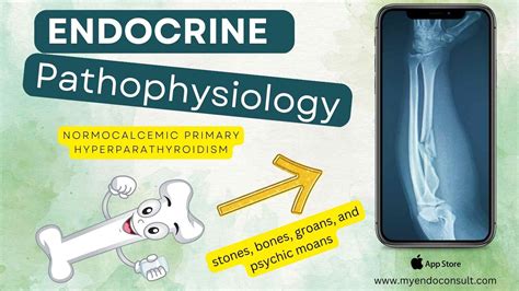 Normocalcemic Primary Hyperparathyroidism My Endo Consult