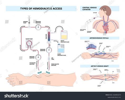 Picc Line Neck