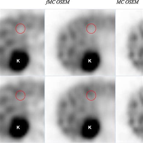 visual demonstration of the disappearance of simulated lesions when