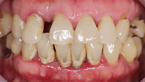 What Is Dental Calculus Atlas Dental Toronto Dentist