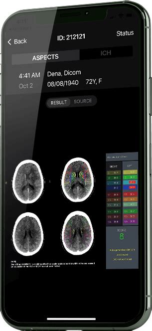 Neuroimaging Stroke Software Platform Powered By Ai Rapidai