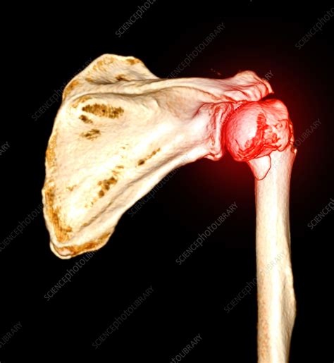 Fractured Shoulder Ct Scan Stock Image F0377174 Science Photo Library