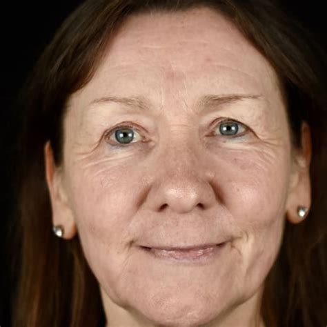 Lower Cheek Wrinkles Dr Darren McKeown