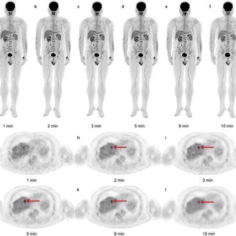 A 56 Year Old Man With Intrahepatic Cholangiocarcinoma The Images Show Download Scientific