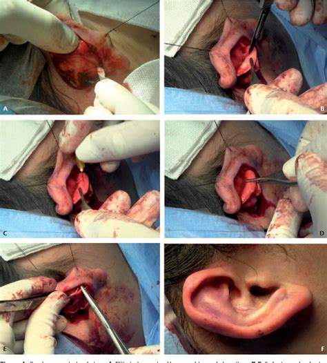 Figure 1 From Otoplasty For Prominent Ears Deformity Semantic Scholar