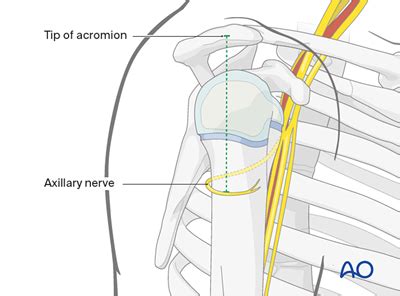 Lateral Approach With Deltoid Splitting