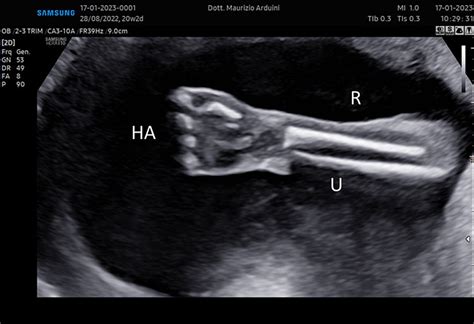 Ultrasound Evaluation Of Normal Second Trimester Fetal Anatomy Article Glowm
