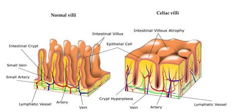 Illustration Of Healthy Mucosa Left And Atrophic Mucosa Right Figure