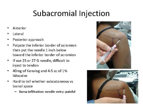 Subacromial Steroid Injection Bursitis Injections For The Shoulder Ultrasound Guided
