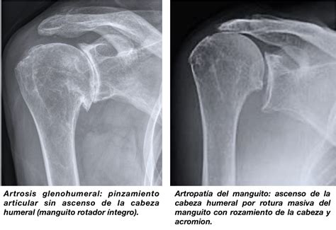 Artrosis De Hombro Synergia