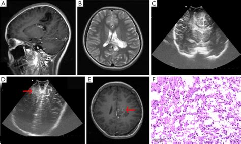 Female 11 Years Old A B Preoperative Mri T1 Sagittal And T2 Download Scientific Diagram