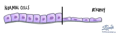Atrophic Mypathologyreport Ca