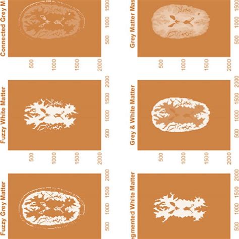 Block Diagram Of Automatic Gray And White Matter Segmentation