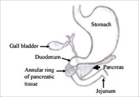 Annular Pancreas