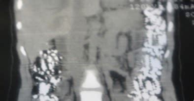 Taif University Clinical Case Of The Week The Mystry Of Colonic Calcification