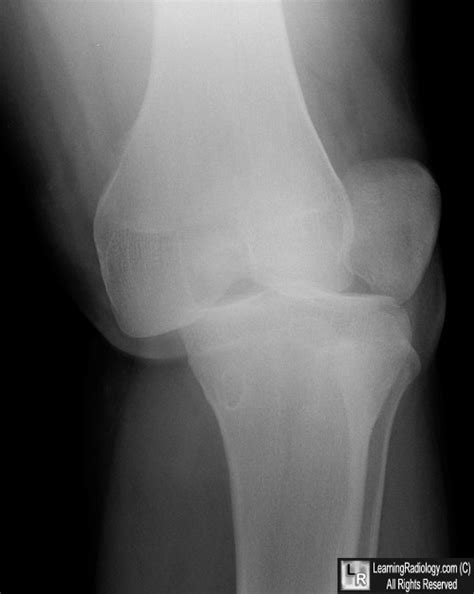 Learningradiology Dislocation Knee Dislocated Femur Tibia Joint