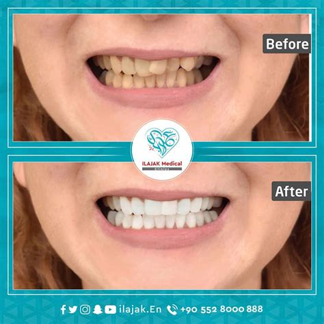 تركيب الأسنان الأمامية دليلك الشامل 2025 علاجك الطبية