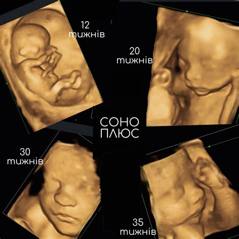 ЗД 4Д УЗД при вагітності