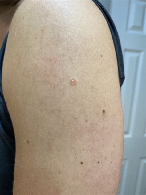 What Is This Rash Ringworm Lyme Or Something Else Dermatologyquestions