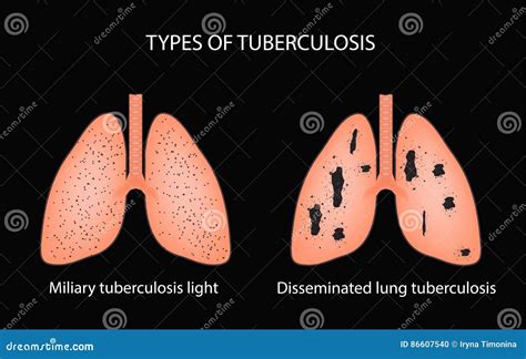 Types Of Tuberculosis Vector Silhouette Medical Illustration Of Human Body Organ