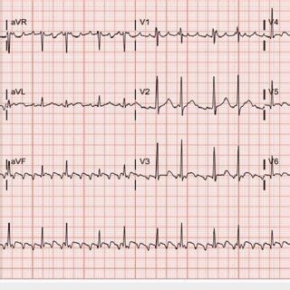 Initial EKG Showing Atrial Flutter Download Scientific Diagram