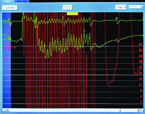 Case 2 Catheterizaton Laboratory Monitor Showing Ecg Artifacts Download Scientific Diagram
