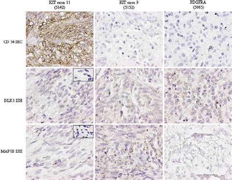 Representative Tma Cores Of Kit Exon 11 Kit Exon 9 And Pdgfra Mutants Download Scientific