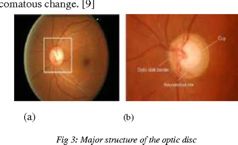 Figure 3 From Optic Disc And Optic Cup Segmentation For Glaucoma Screening Using Superpixel