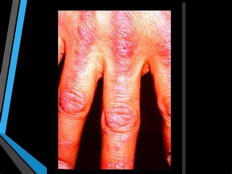 Dermatomiosite Polimiosite