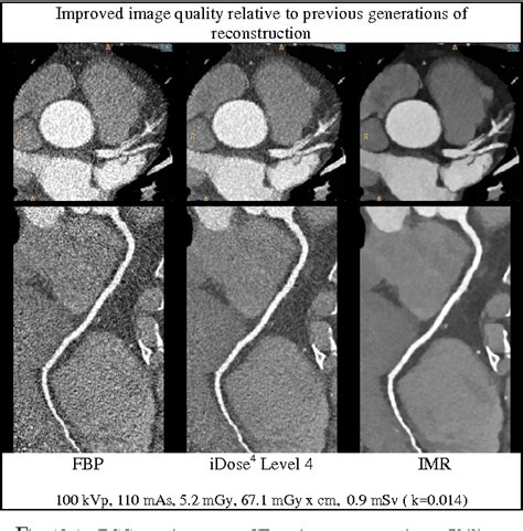 Figure 13 From Innovations Iterative Model Reconstruction Simultaneously Lowered Computed