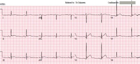 Early Repolarization Or Anterior Stemi Ecg Cases Em Cases