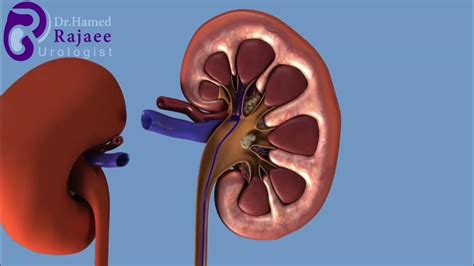 فیلم واقعی جراحی سنگ کلیه با لیزر Youtube