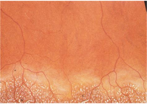 Cystoid Degeneration