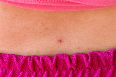 고개를 끄덕인 낭포성 여드름 피부의 사진 여성 표면에 만성 여드름 피부 여드름 문제가있는 여성 호르몬과 흉터로 인한 얼굴 피부에 여드름을 닫습니다 건강관리와 의술에 대한