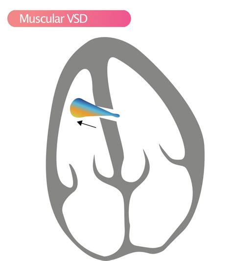 Echocardiography Muscular Vsd Ventricular Septal Defect The