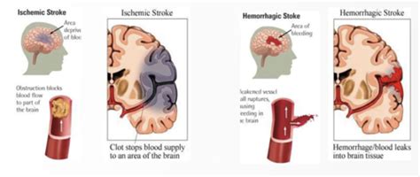 Acute CVA Flashcards Quizlet Acute CVA Flashcards Quizlet
