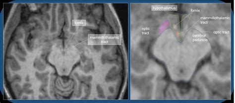 Hypothalamus Ht🧵 The Control Center Of Circadian Rhythm Fatigue