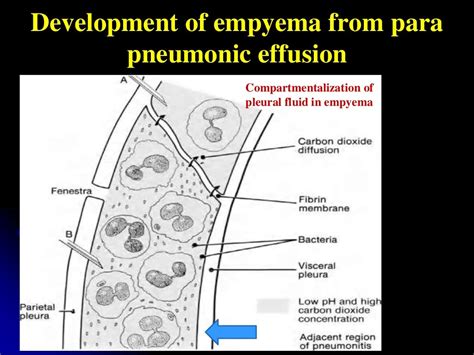 Aetiopathogenesis And Management Of Empyema Thoracis