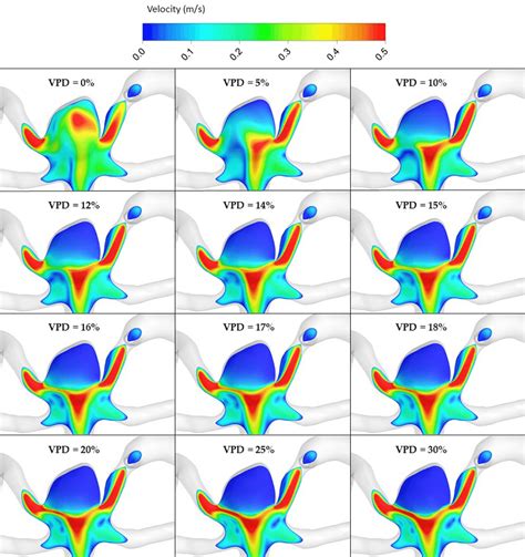 Velocity Distribution At Aneurysm Cross Section For Selected Vpd Cases