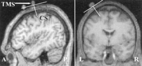 Position And Orientation Of Tms Coil Tms Relative To The Central Download Scientific Diagram