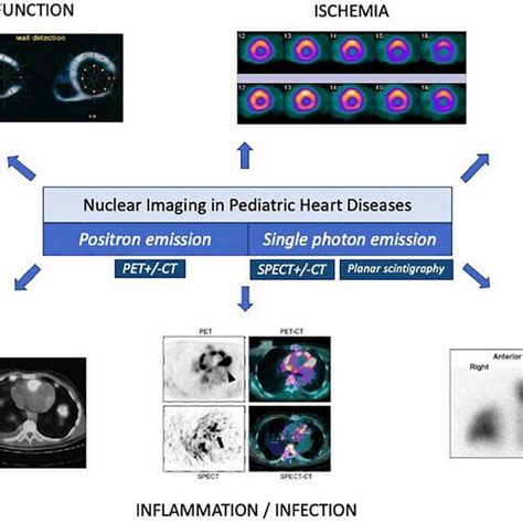 Lung Perfusion Planar Scintigraphy A Normal Lung Perfusion