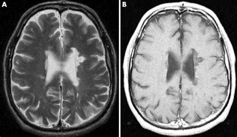 Ms Mri Brain Scan Results