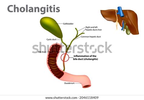 Cholangitis Images Stock Photos Vectors Shutterstock