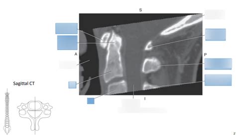 Sagittal Ct Diagram Quizlet