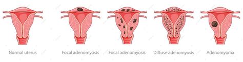 human female reproductive system icons adenomyosis focal diffuse